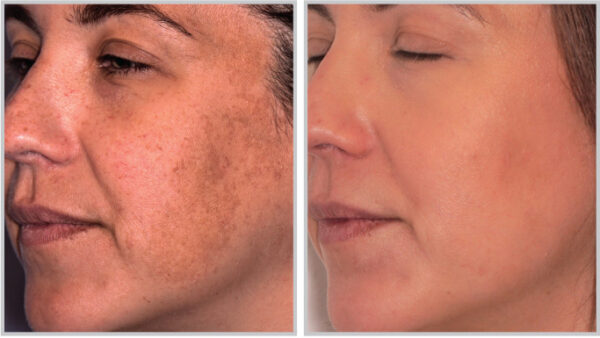 BBL Laser Treatments - LISSÈ Medical Aesthetics - Gig Harbor, WA