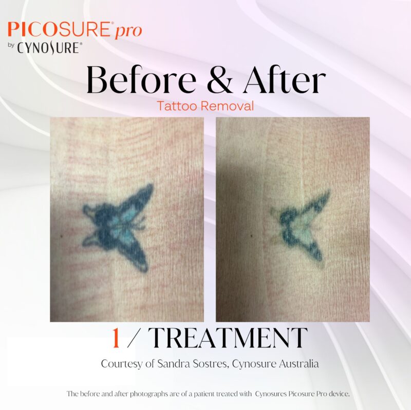 Laser Tattoo Removal at LISSÈ Medical Aesthetics - Gig Harbor, WA