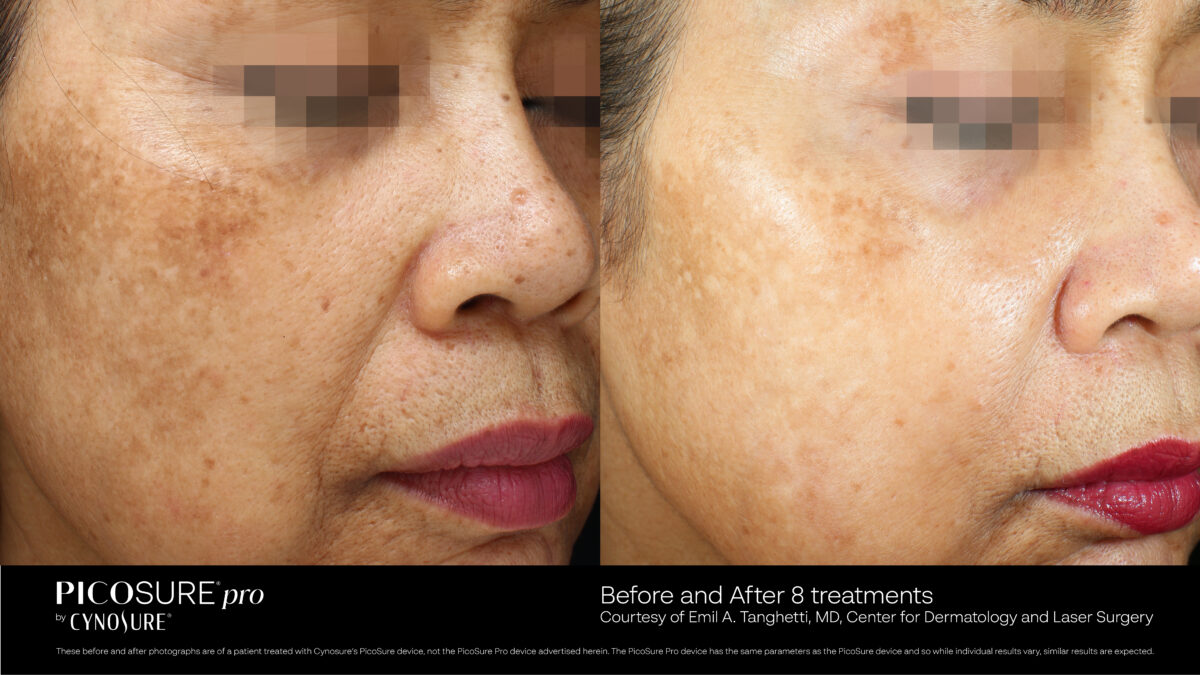 Laser Tattoo Removal at LISSÈ Medical Aesthetics - Gig Harbor, WA